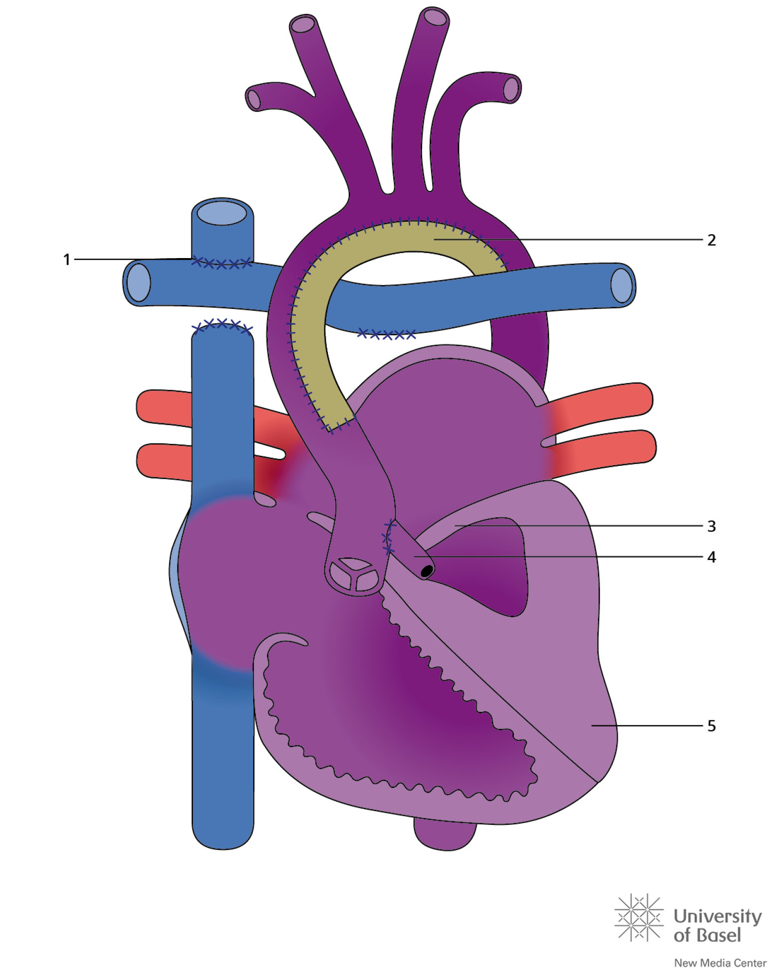 Hypoplastisch linker hart syndroom – CAHAL