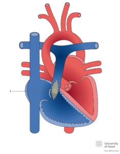 Pulmonaal stenose – CAHAL