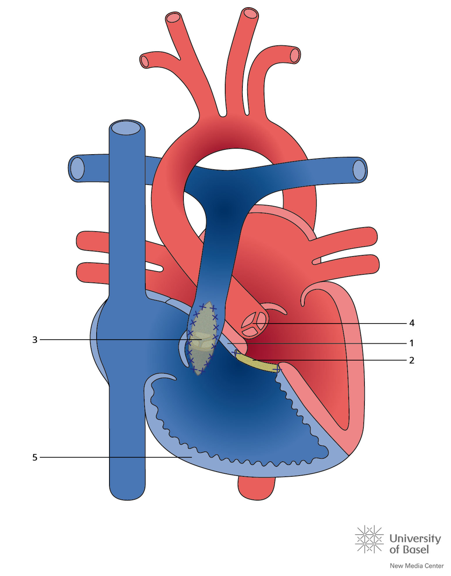 Tetralogie van Fallot – CAHAL