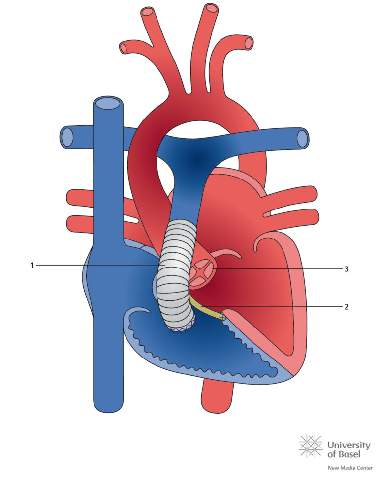 Truncus Arteriosus – CAHAL